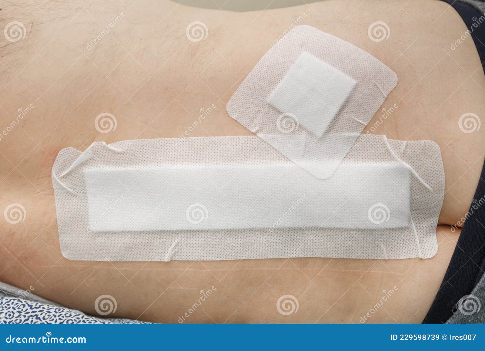 Postoperative Suture Sealed with Plaster Stock Image - Image of love ...