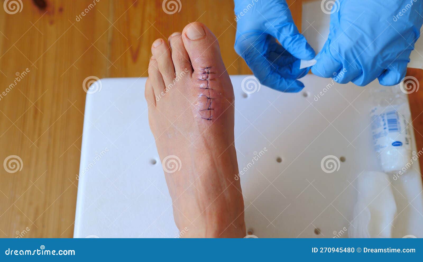 Postoperative Sutures on the Foot Stock Photo - Image of health ...
