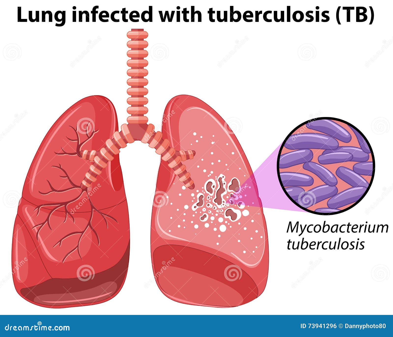 Poumon Atteint De La Tuberculose Illustration de Vecteur - Illustration ...