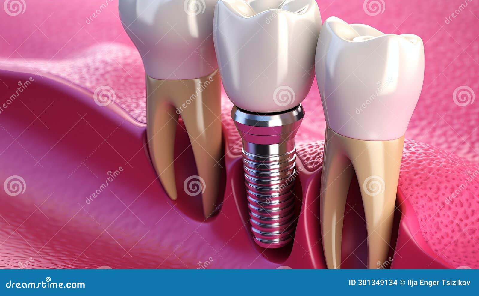 Precise Dental Implant Fitting Illustration Demonstrating Technique on ...