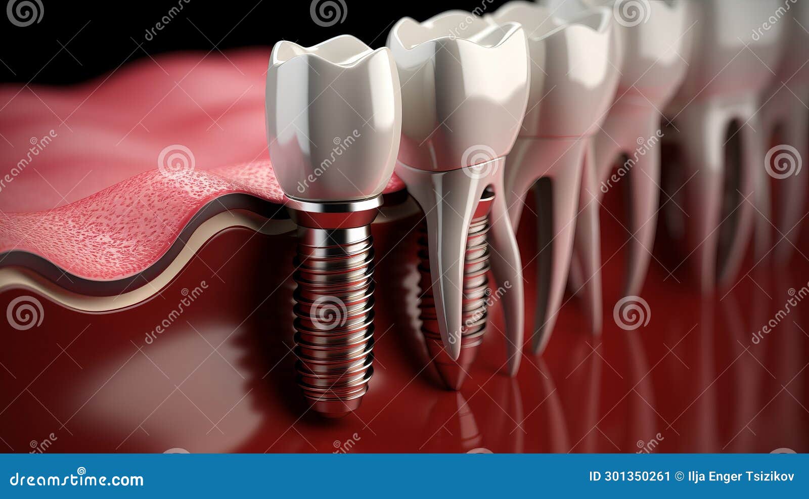 Precise Dental Implant Fitting Intricate Illustration Demonstrating ...