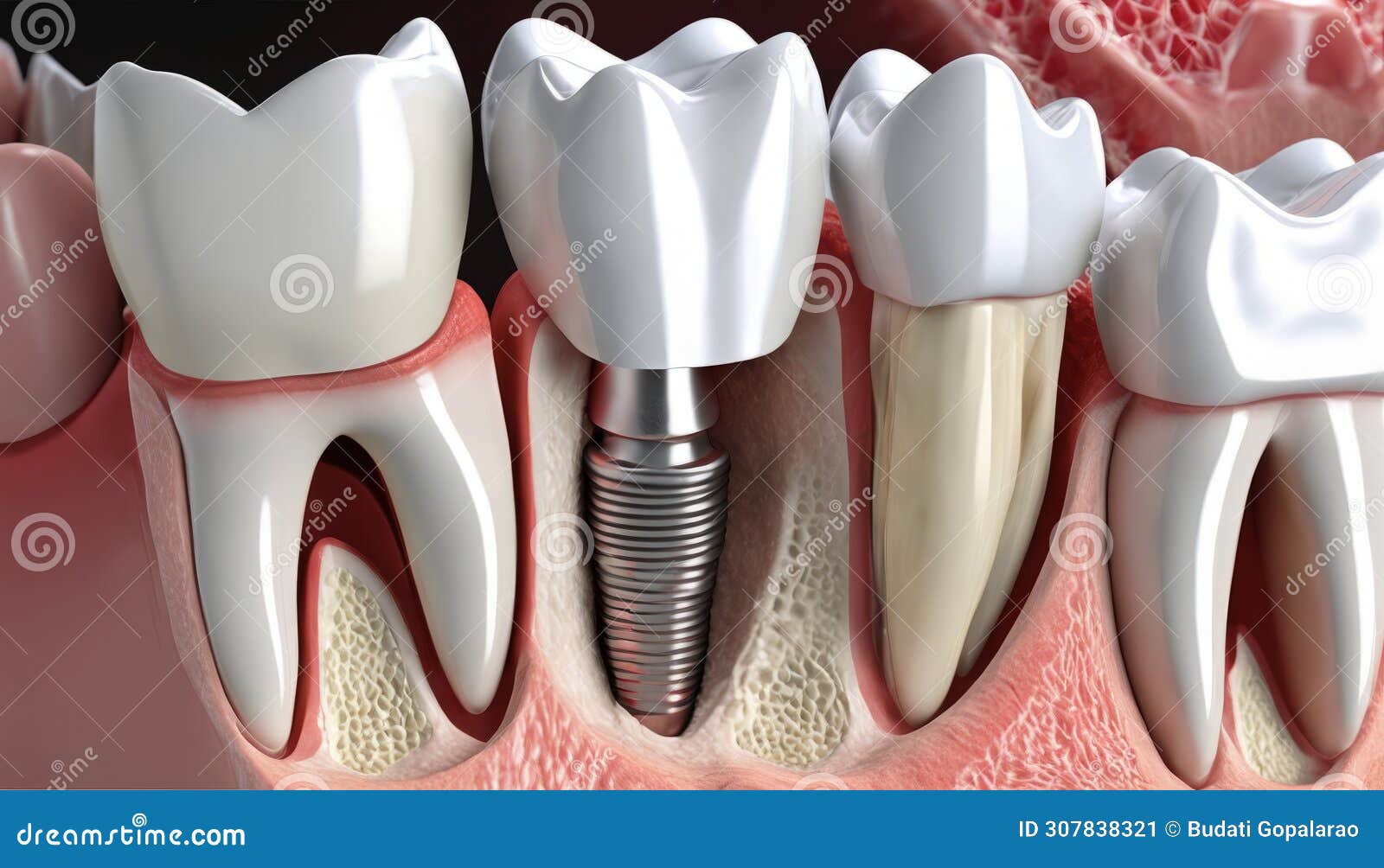 Precision Dental Implant Fitting Detailed Illustration Of Implant ...