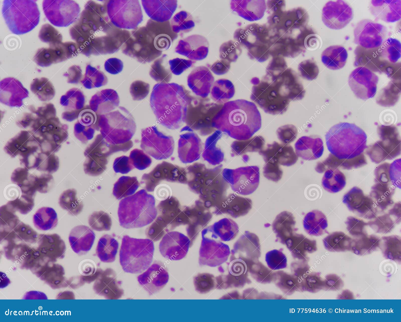 A Precursor Cell, Also Called a Blast Cell or Simply Blast, is a Stock ...