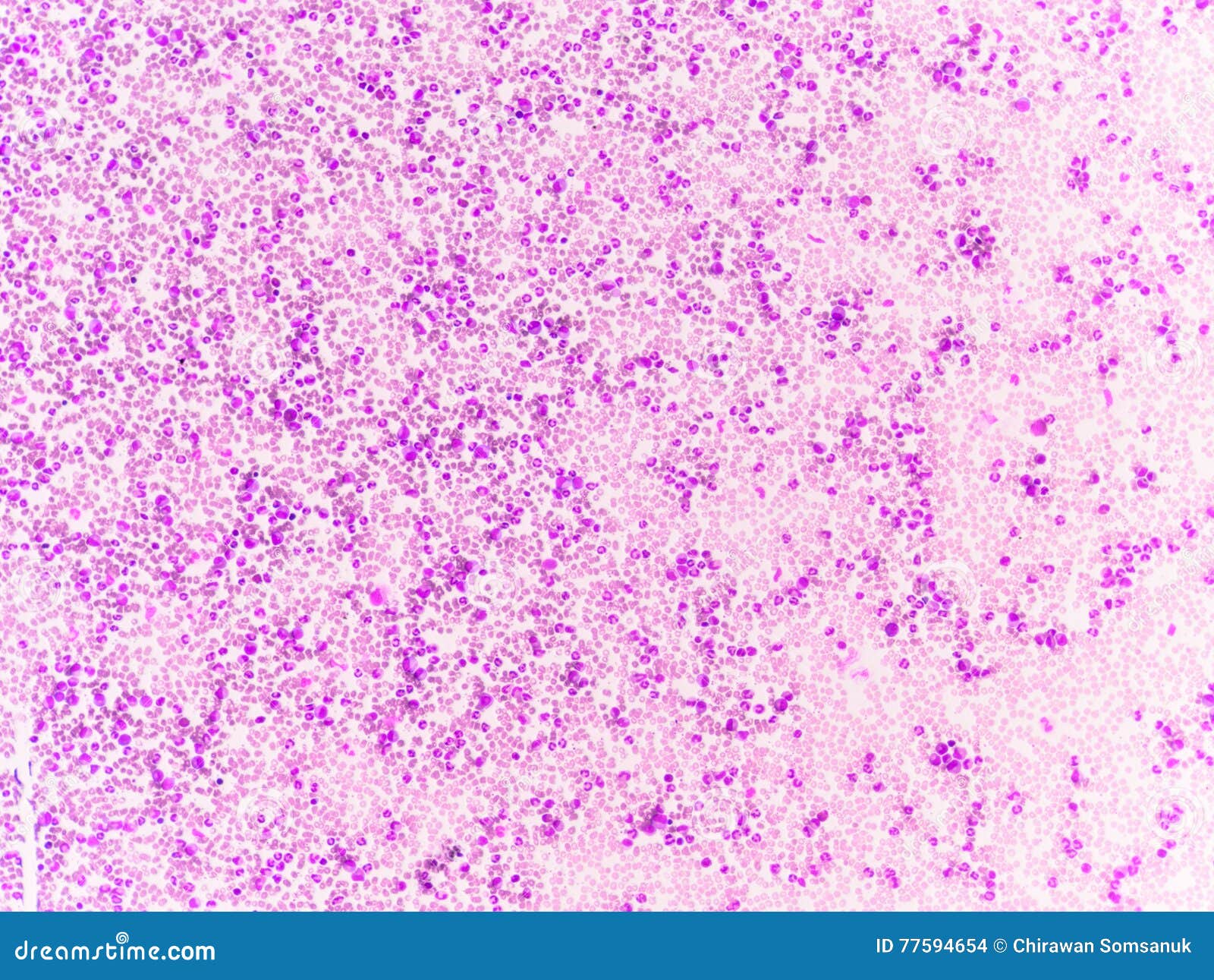 A Precursor Cell, Also Called a Blast Cell or Simply Blast, is a Stock ...