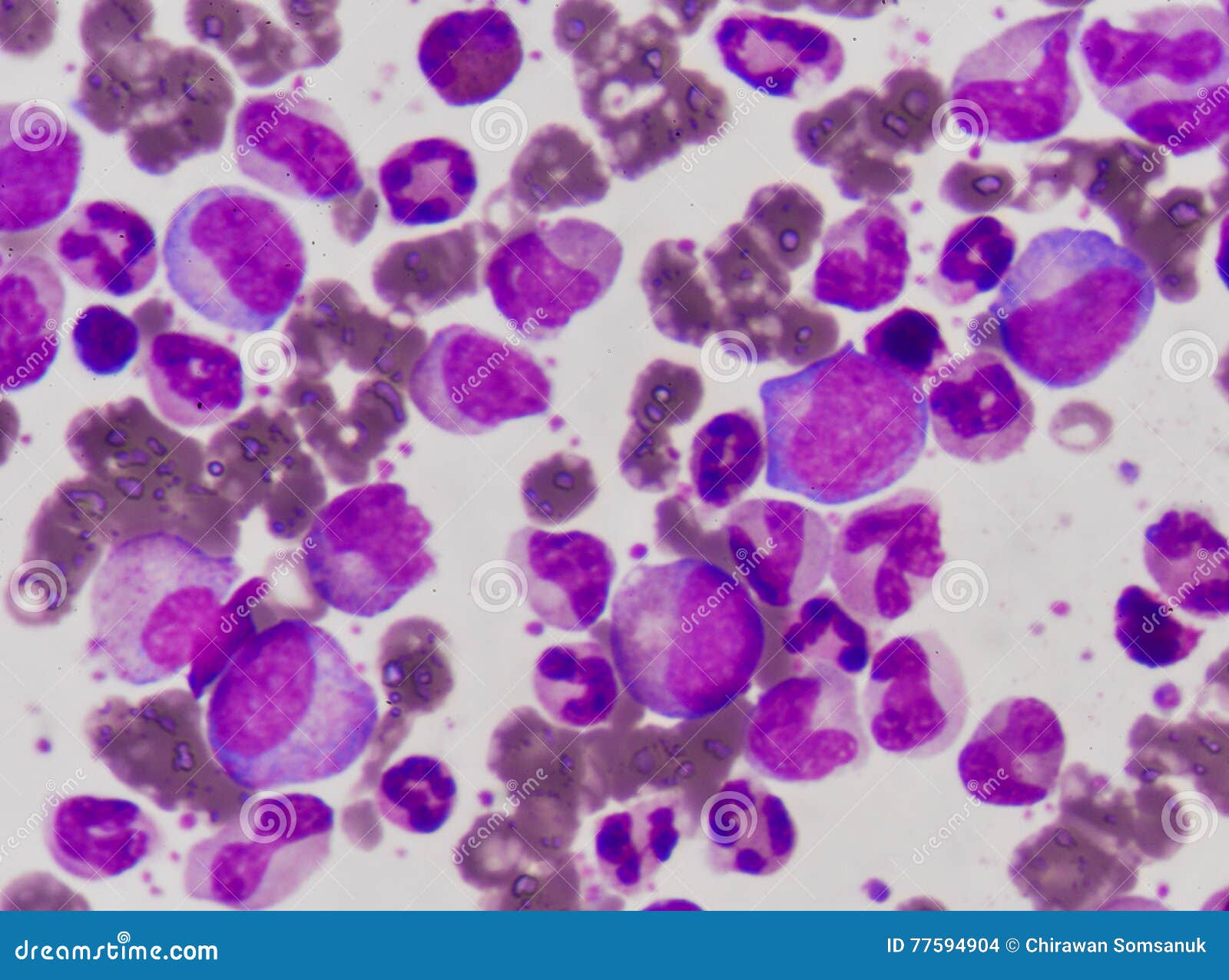 A Precursor Cell, Also Called a Blast Cell or Simply Blast, is a Stock ...