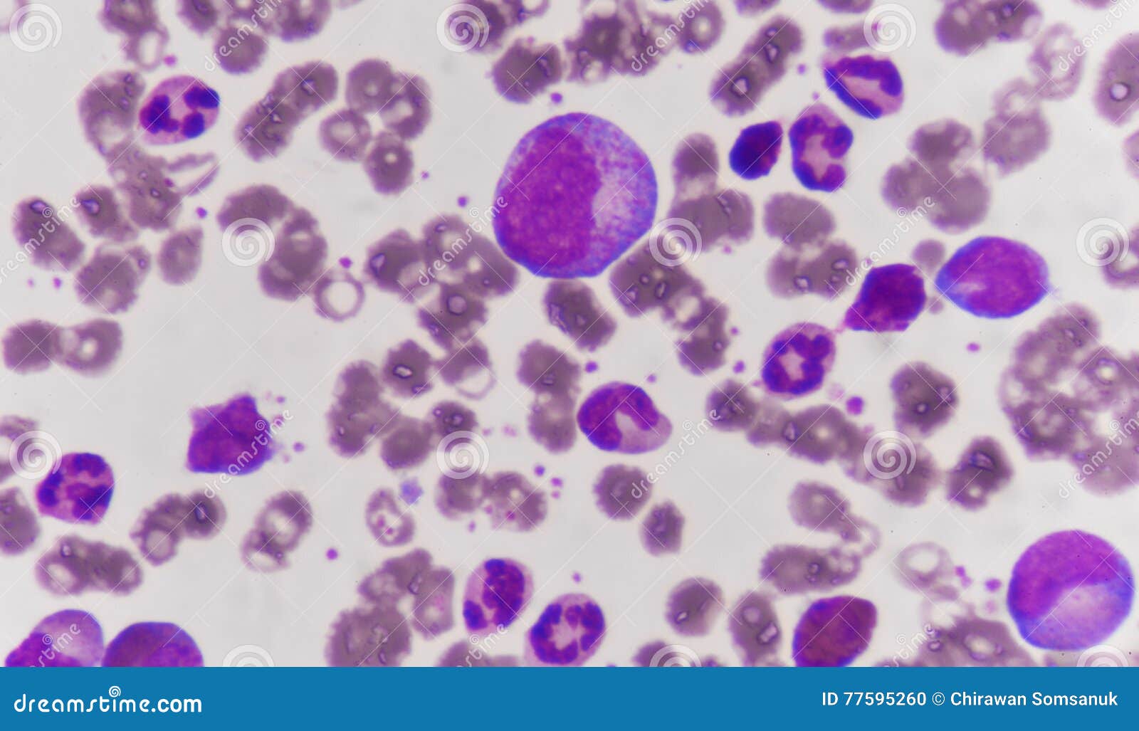 A Precursor Cell, Also Called a Blast Cell or Simply Blast, is a Stock ...