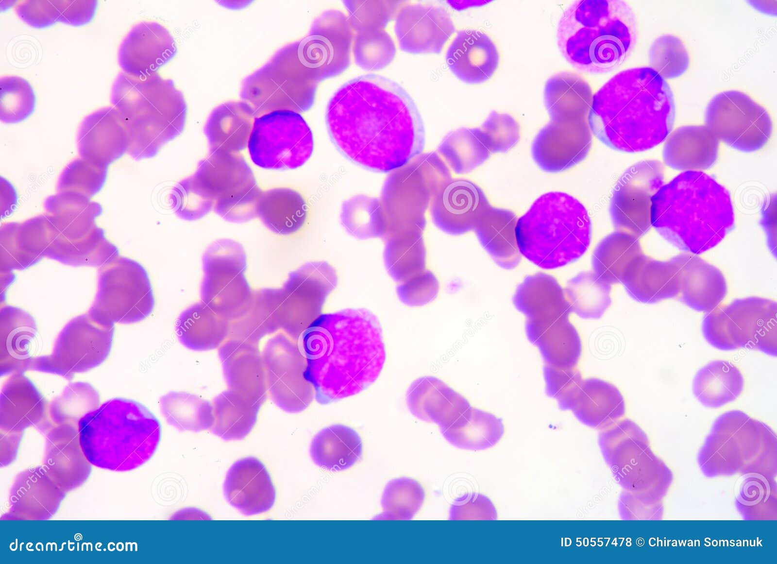 Precursor Cell on Blood Smear. Stock Photo - Image of colony ...