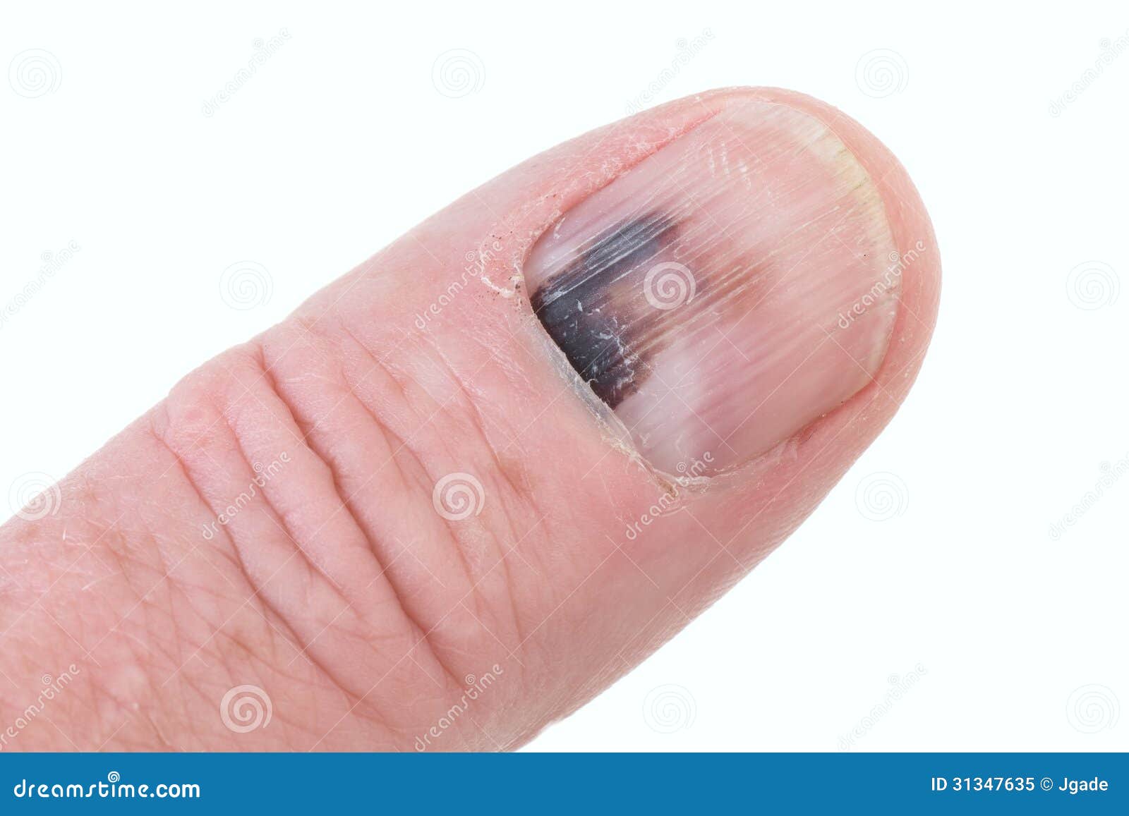 Prego ferido do dedo imagem de stock. Imagem de dedo - 31347635