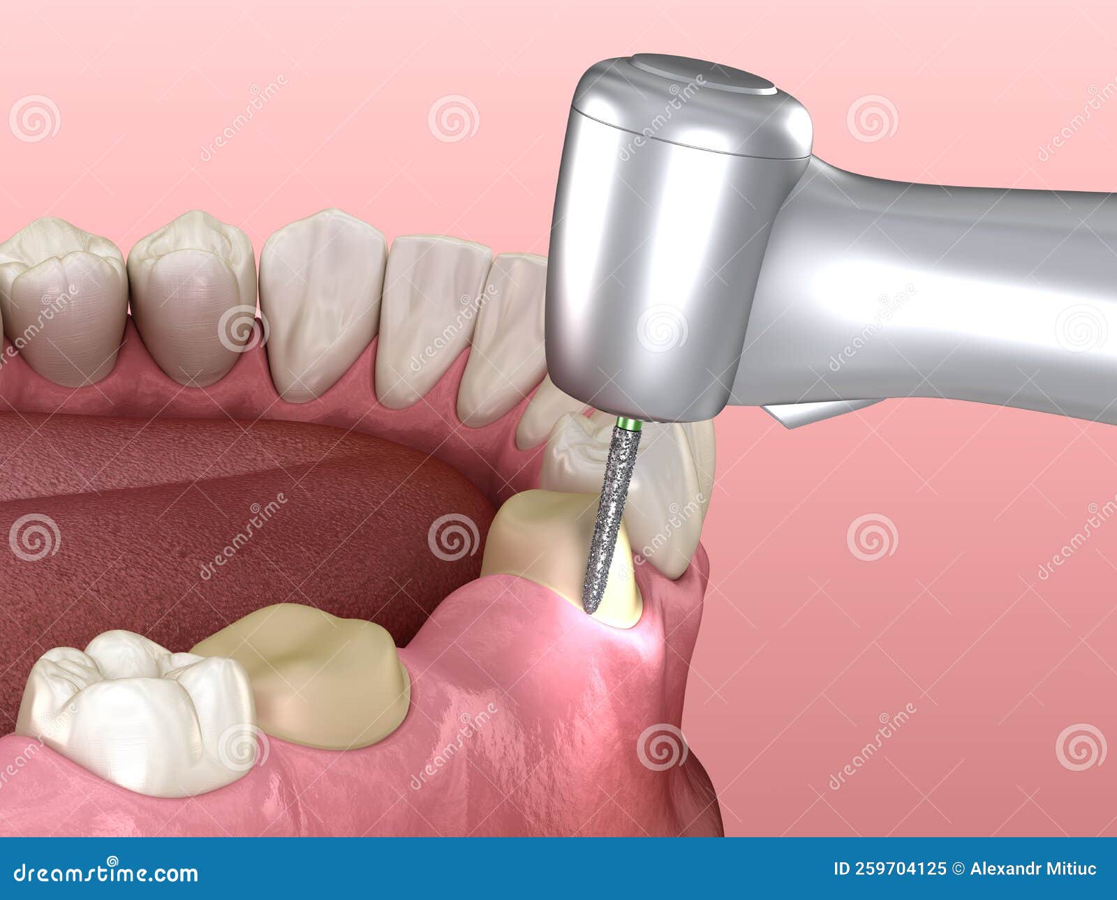 Premolar Preparation Process for Dental Crown Placement. Medically ...