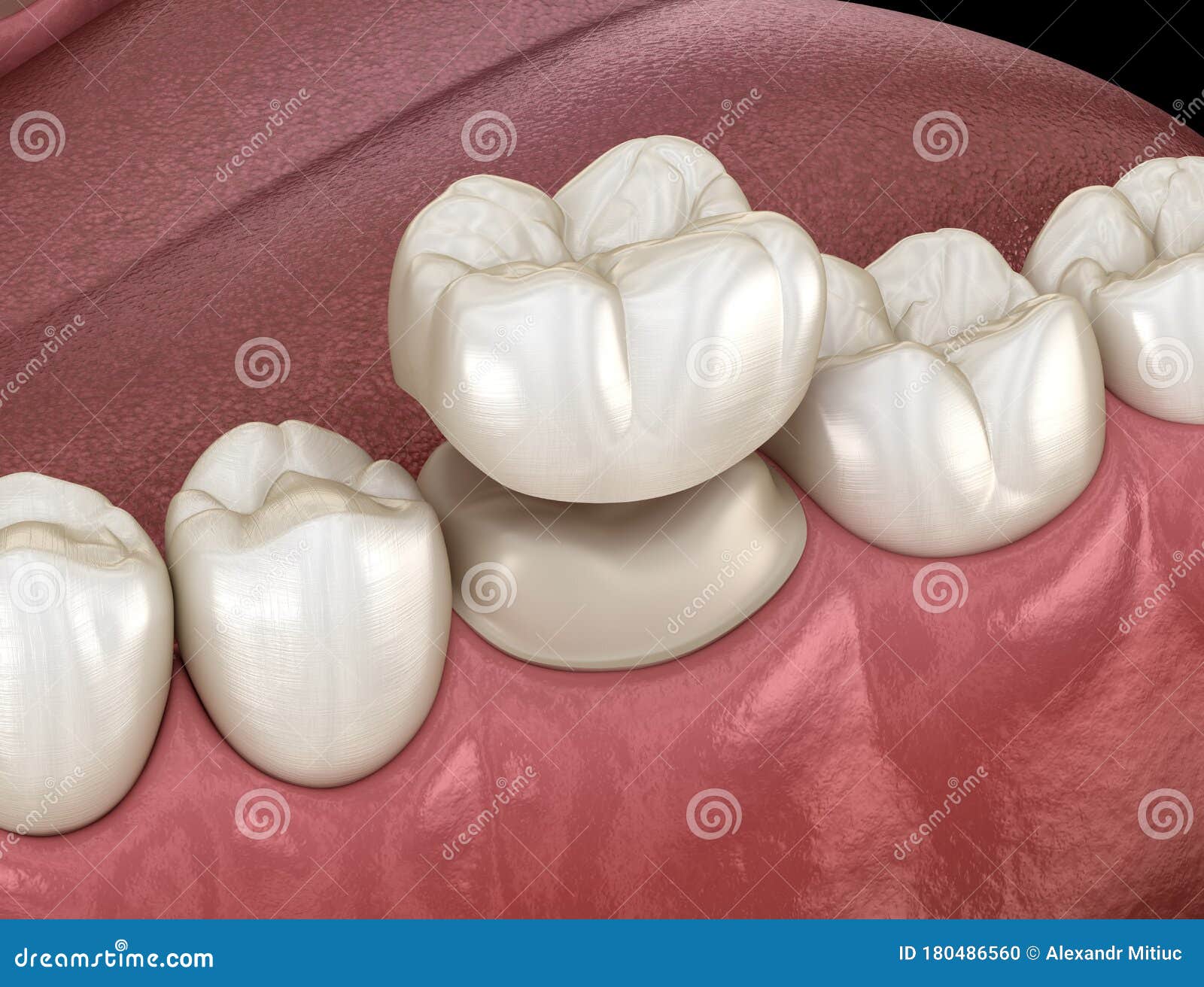 Preparated Molar And Premolar Tooth For Dental Bridge Placement ...