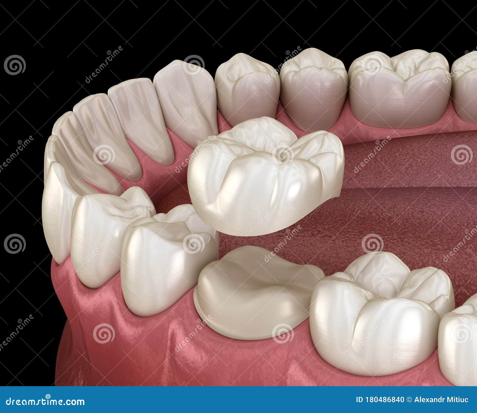 Preparated Molar Tooth for Dental Crown Placement. Medically Accurate ...