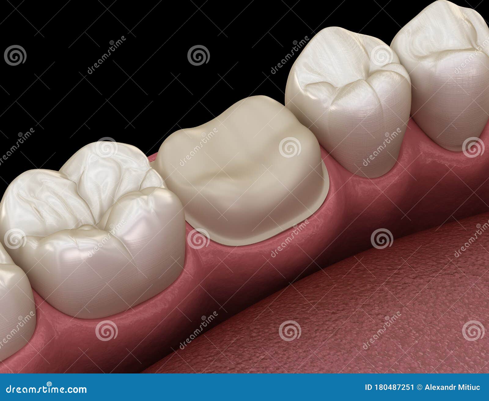 Preparated Molar And Premolar Tooth For Dental Bridge Placement ...