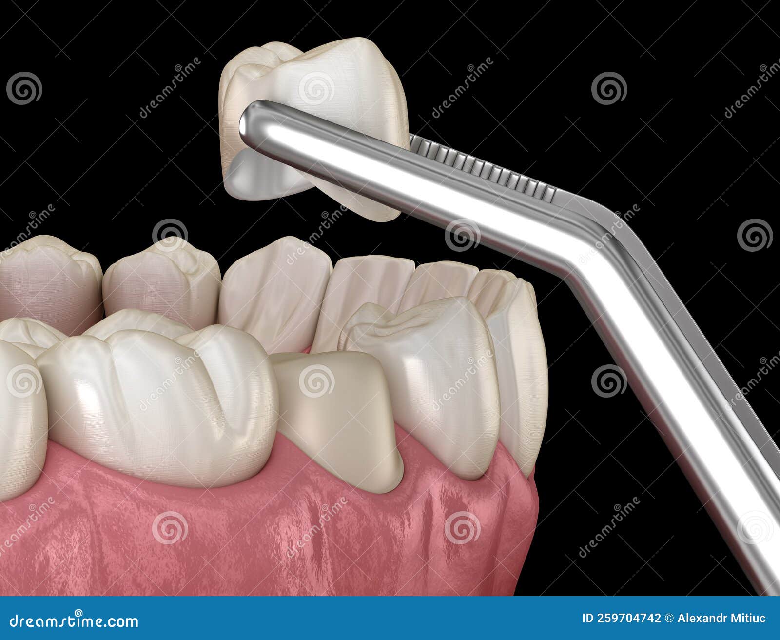 Preparated Premolar Tooth and Ceramic Crown Placement. Medically ...