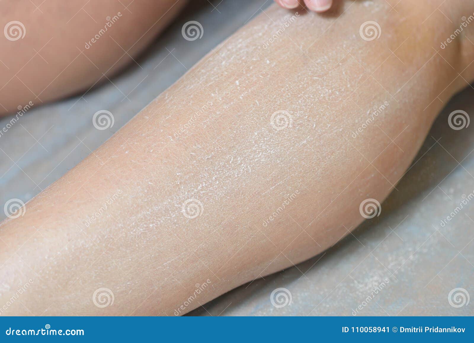 Preparation of Skin for Sugaring. the Skin is Treated with a Pow Stock ...