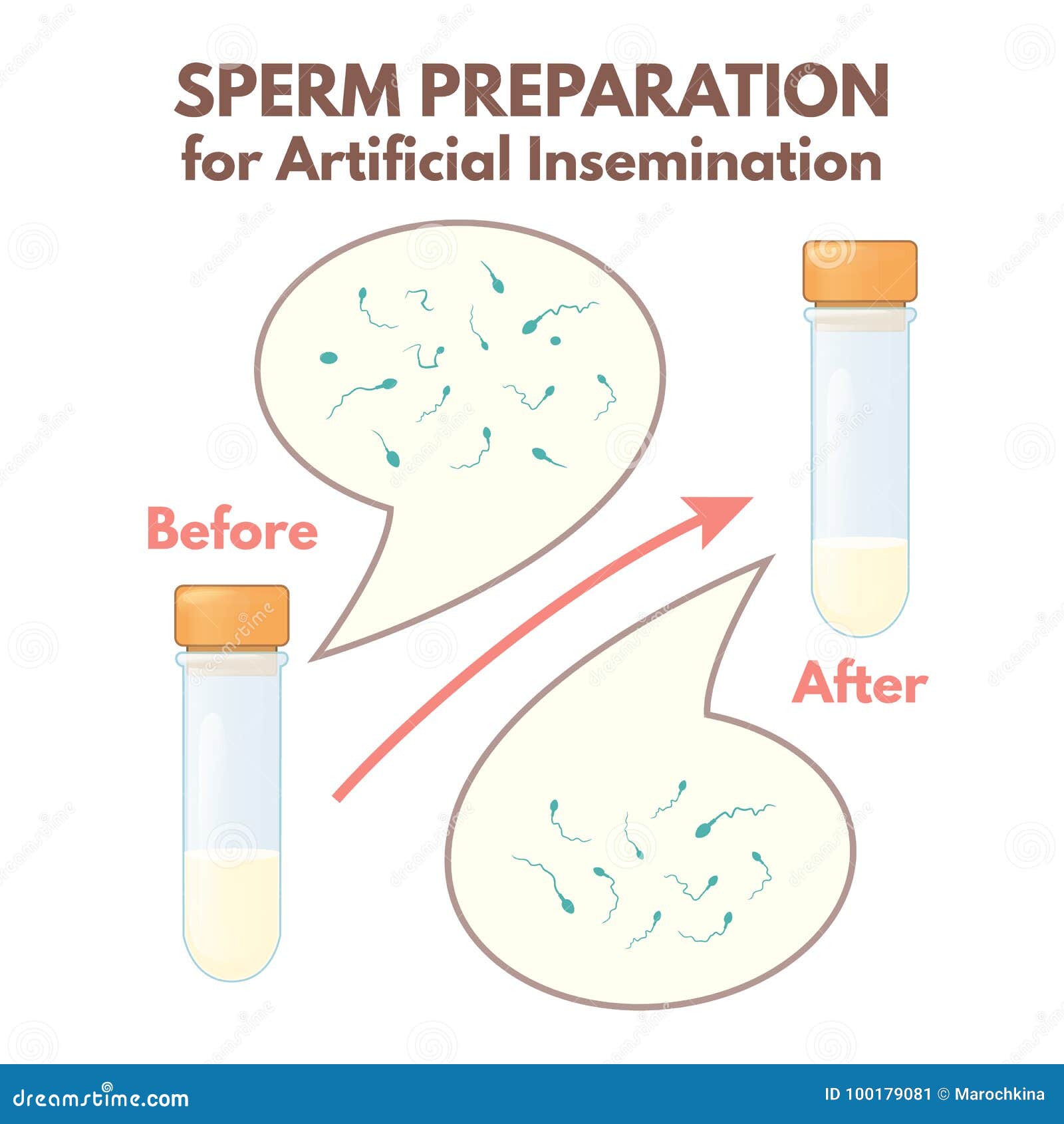 Preparation Of Sperm Stock Vector Illustration Of Sperm 100179081