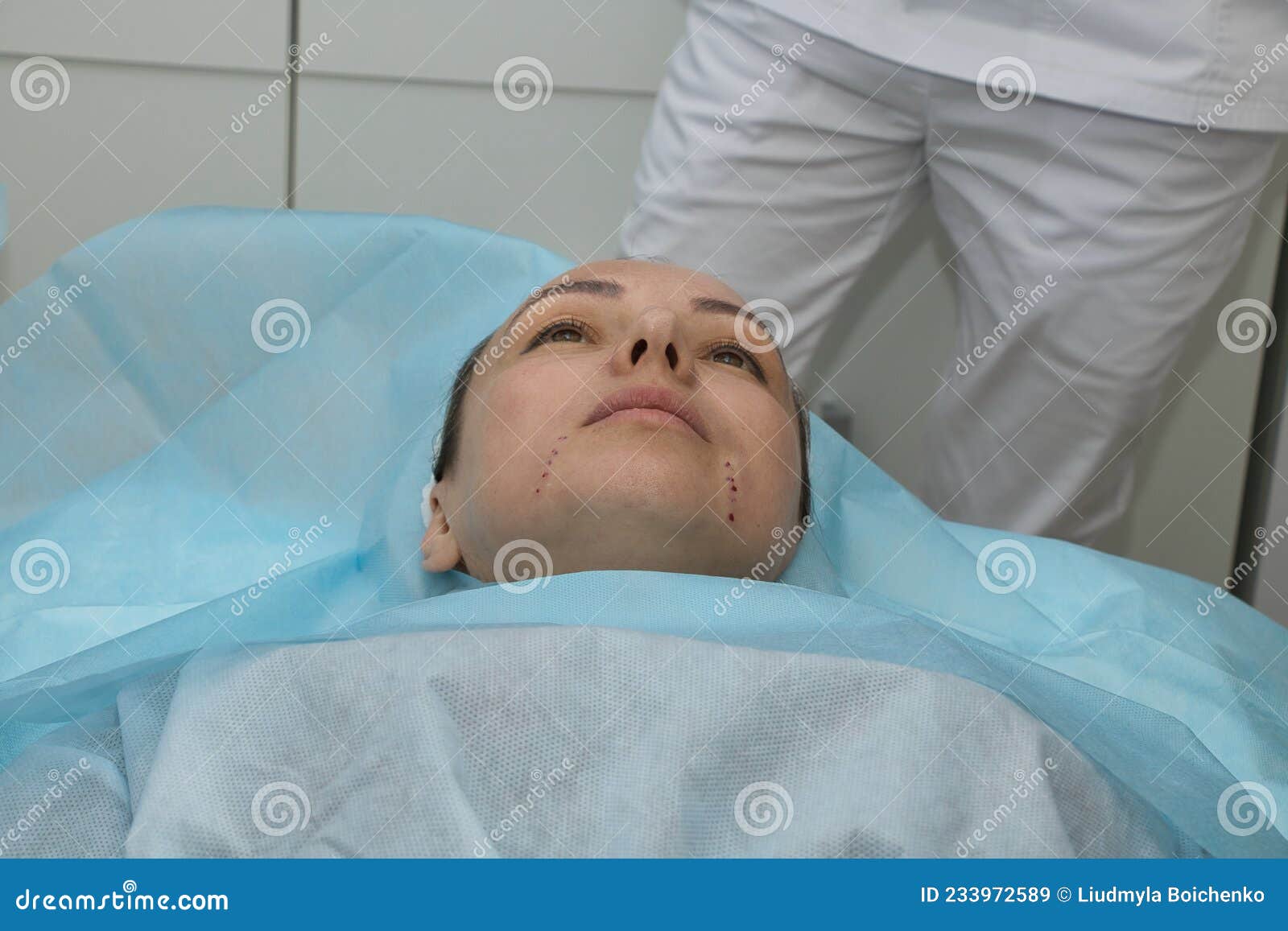 Preparing the Patient for the Cosmetic Thread Lifting Procedure. Stock ...