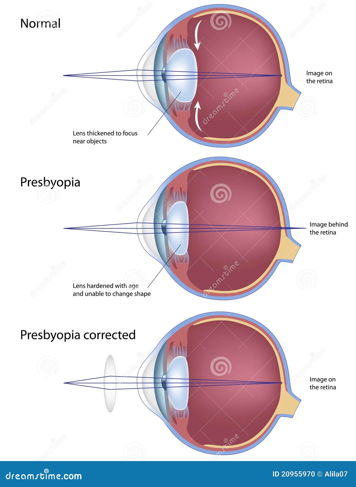 Presbyopia stock vector. Illustration of disc, learn - 20955970