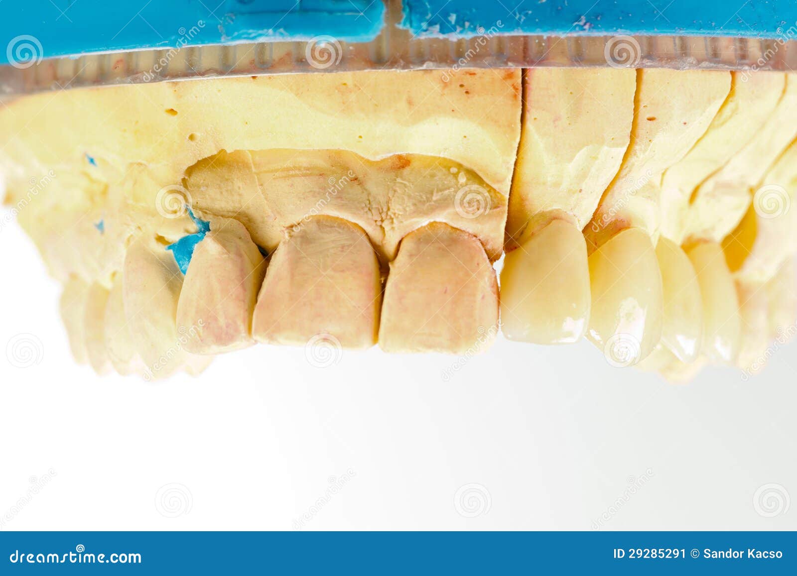 Pressed ceramic teeth stock image. Image of tooth, medical - 29285291