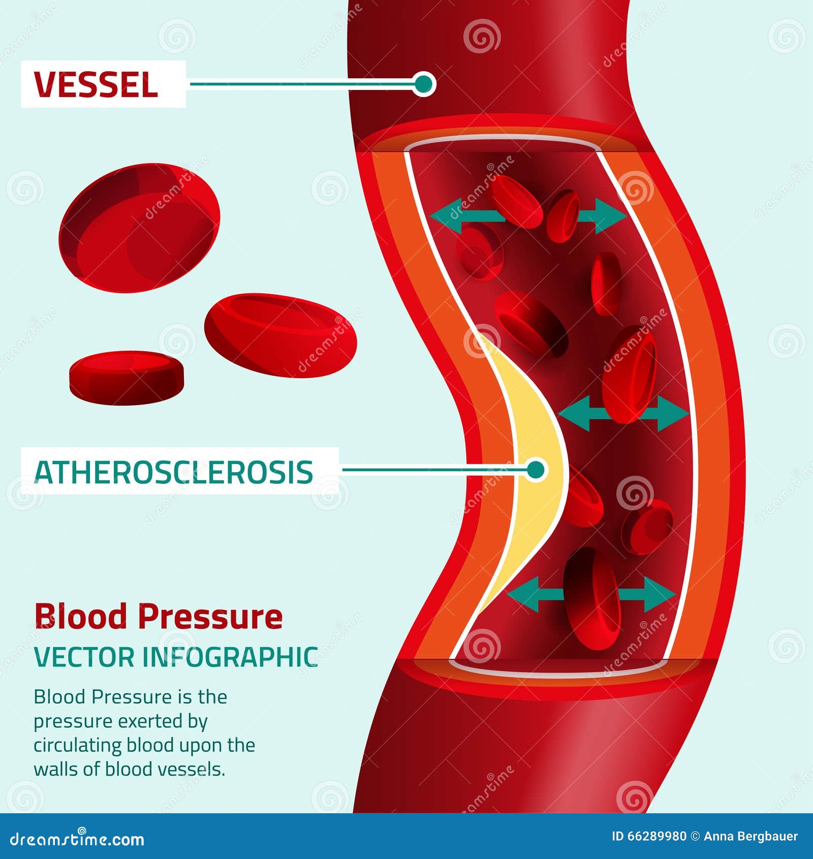 Pressione Sanguigna Infographic Illustrazione Vettoriale ...