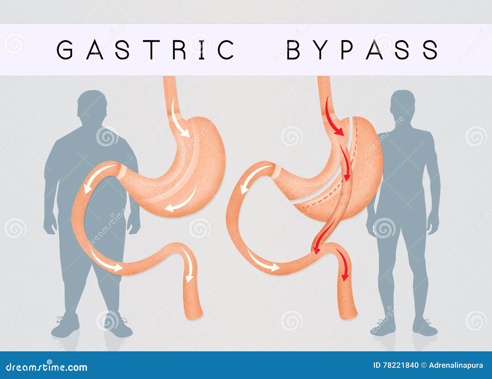 Bypass Gastrico Prima E Dopo Dopo L'intervento Di Bypass Gastrico