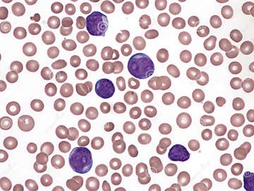 Primary Cutaneous Diffuse Large B-cell Lymphoma, Leg Type. Stock Photo ...