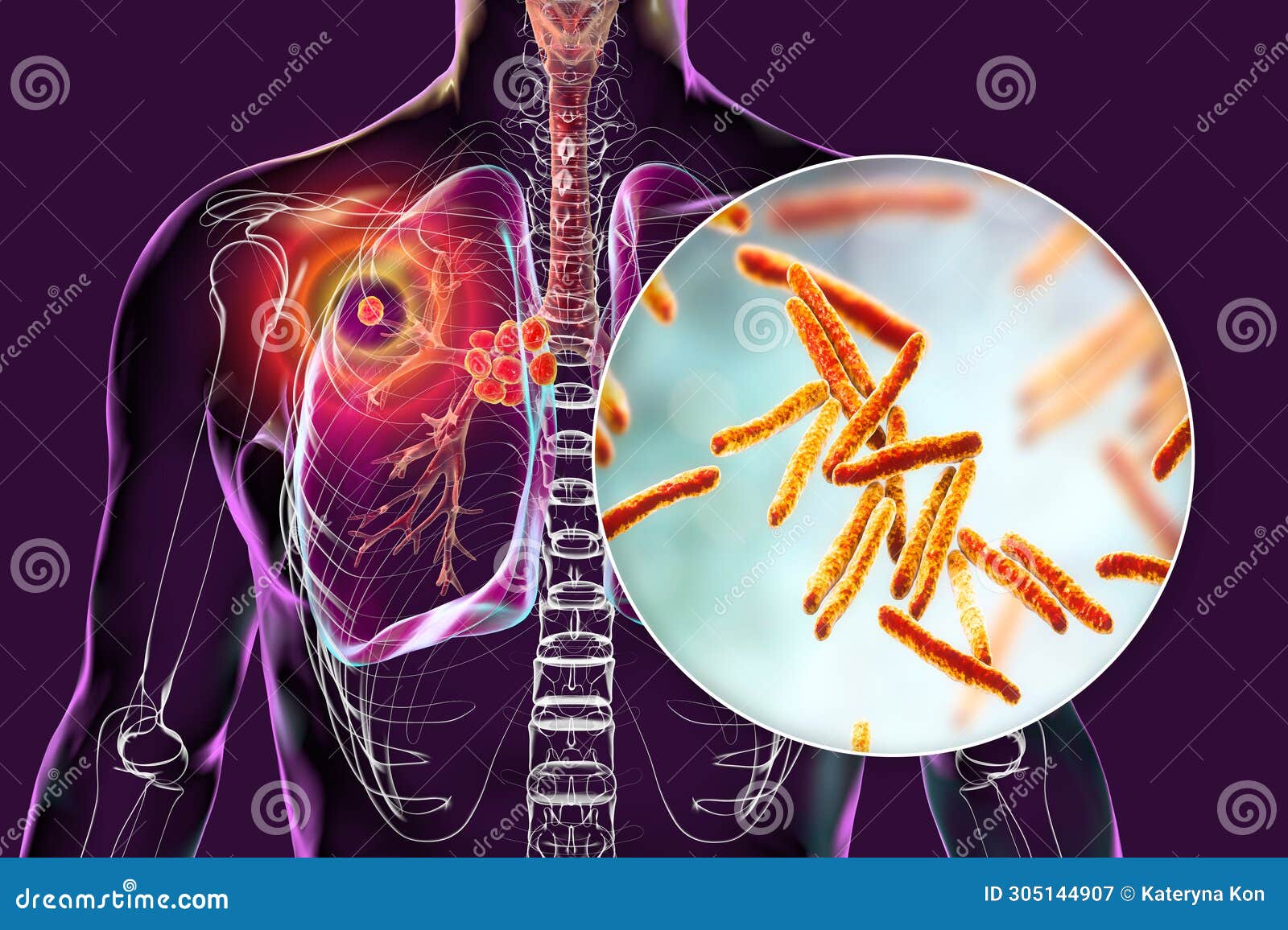 Primary Lung Tuberculosis, 3D Illustration | CartoonDealer.com #305144907