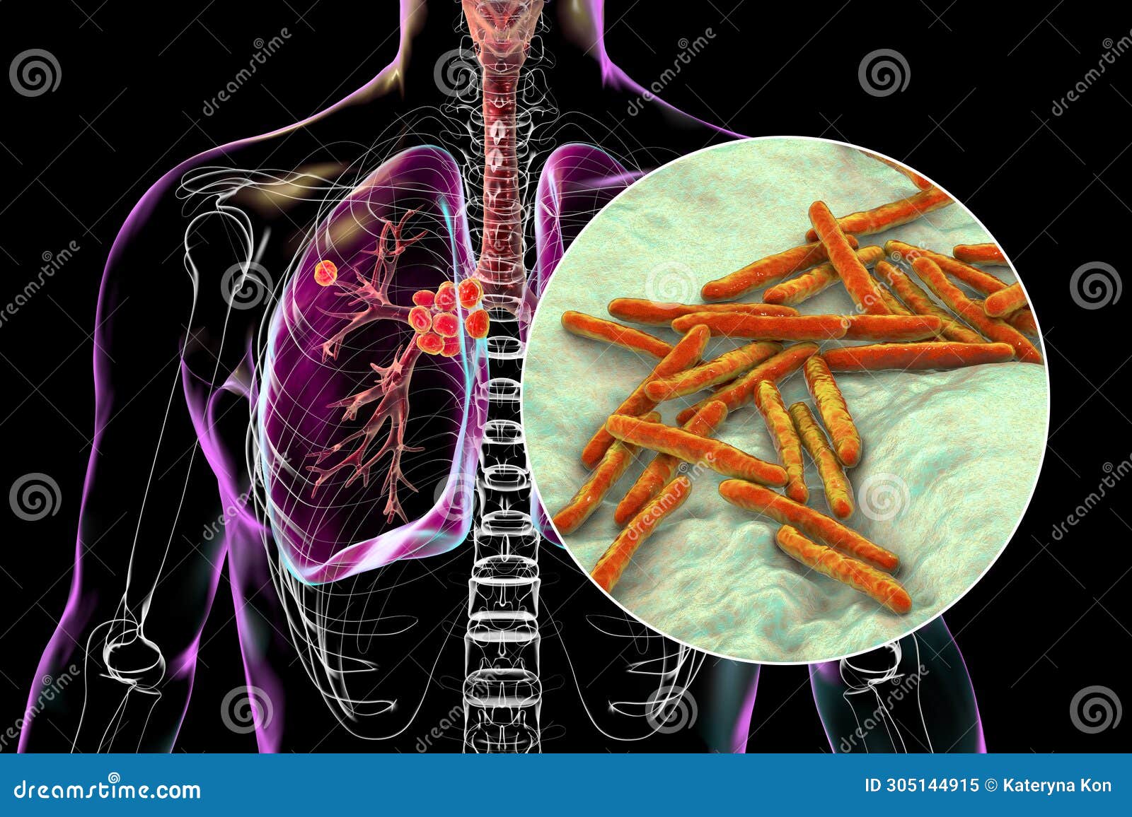 Primary Lung Tuberculosis, 3D Illustration Stock Illustration ...