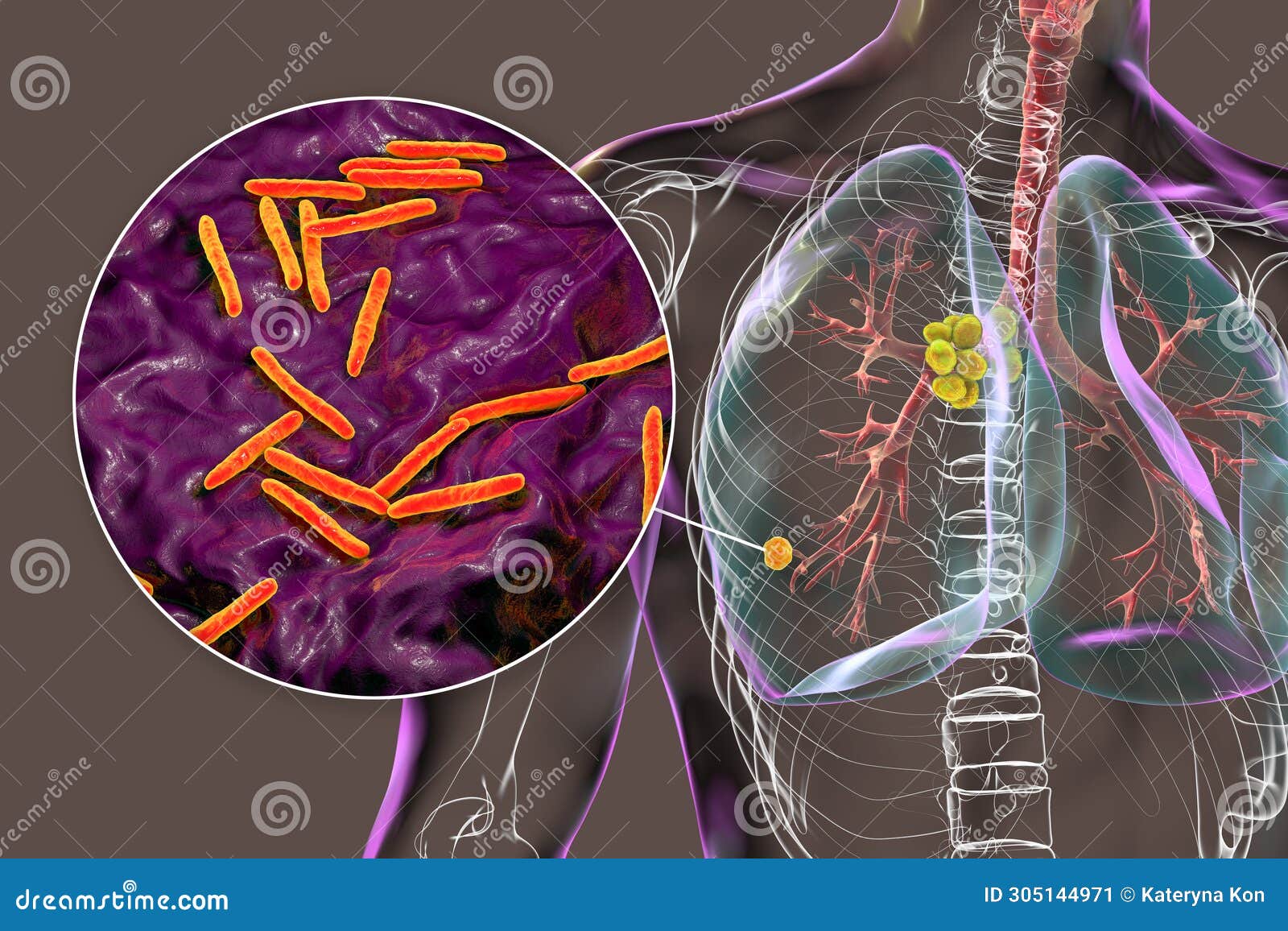 Primary Lung Tuberculosis, 3D Illustration | CartoonDealer.com #305144971
