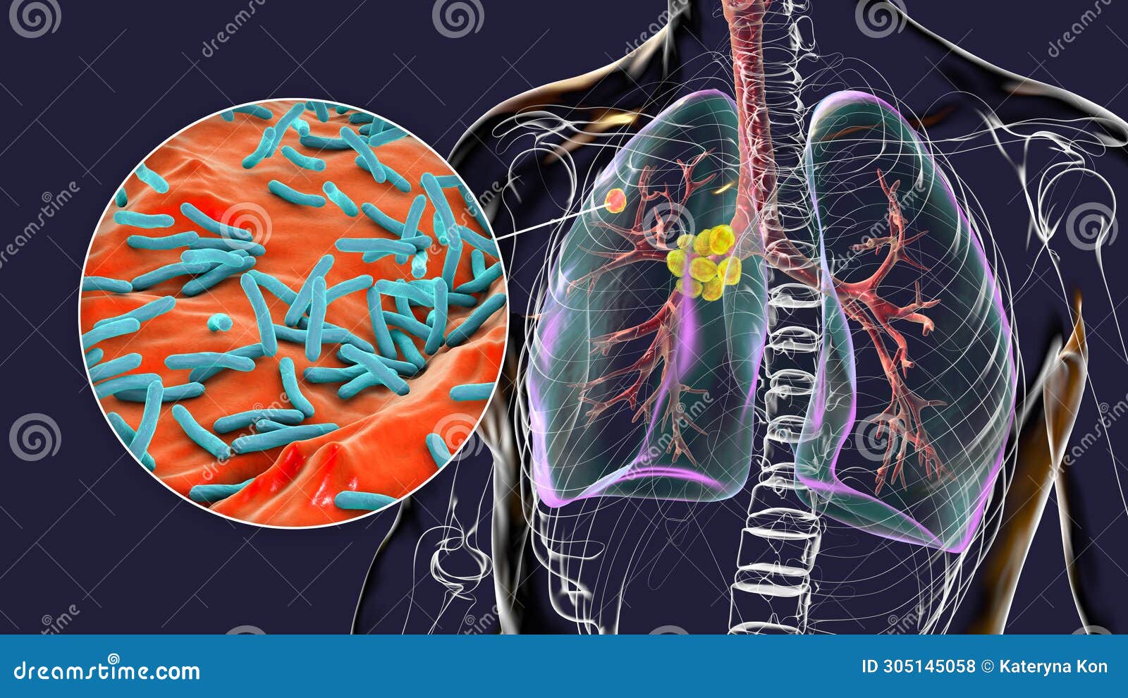 Primary Lung Tuberculosis, 3D Illustration Stock Illustration ...