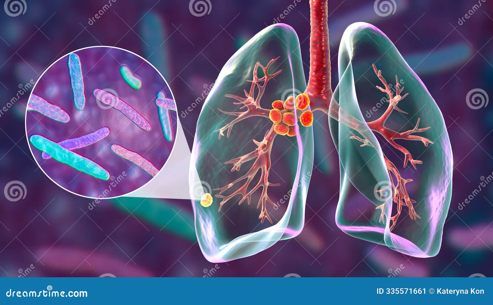 Primary Lung Tuberculosis, 3D Illustration Stock Illustration ...