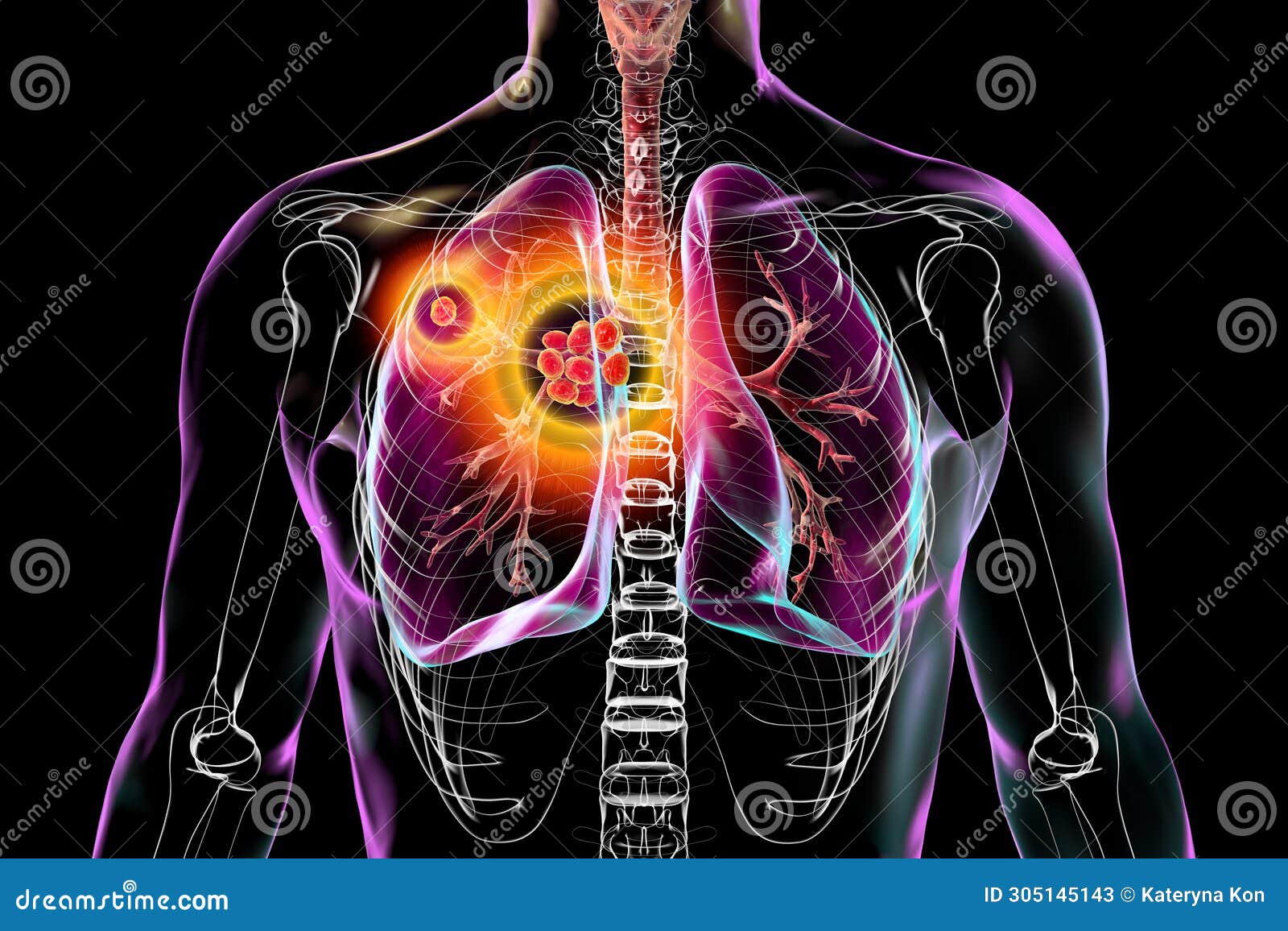 Primary Lung Tuberculosis, 3D Illustration Stock Illustration ...