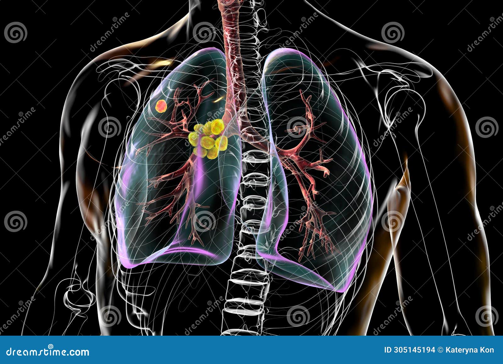 Primary Lung Tuberculosis, 3D Illustration Stock Illustration ...
