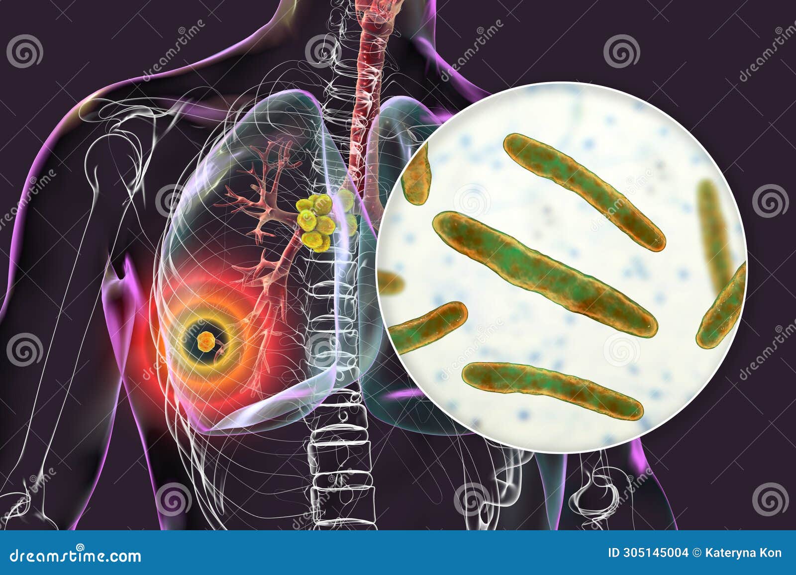 Primary Lung Tuberculosis, 3D Illustration Royalty-Free Cartoon ...