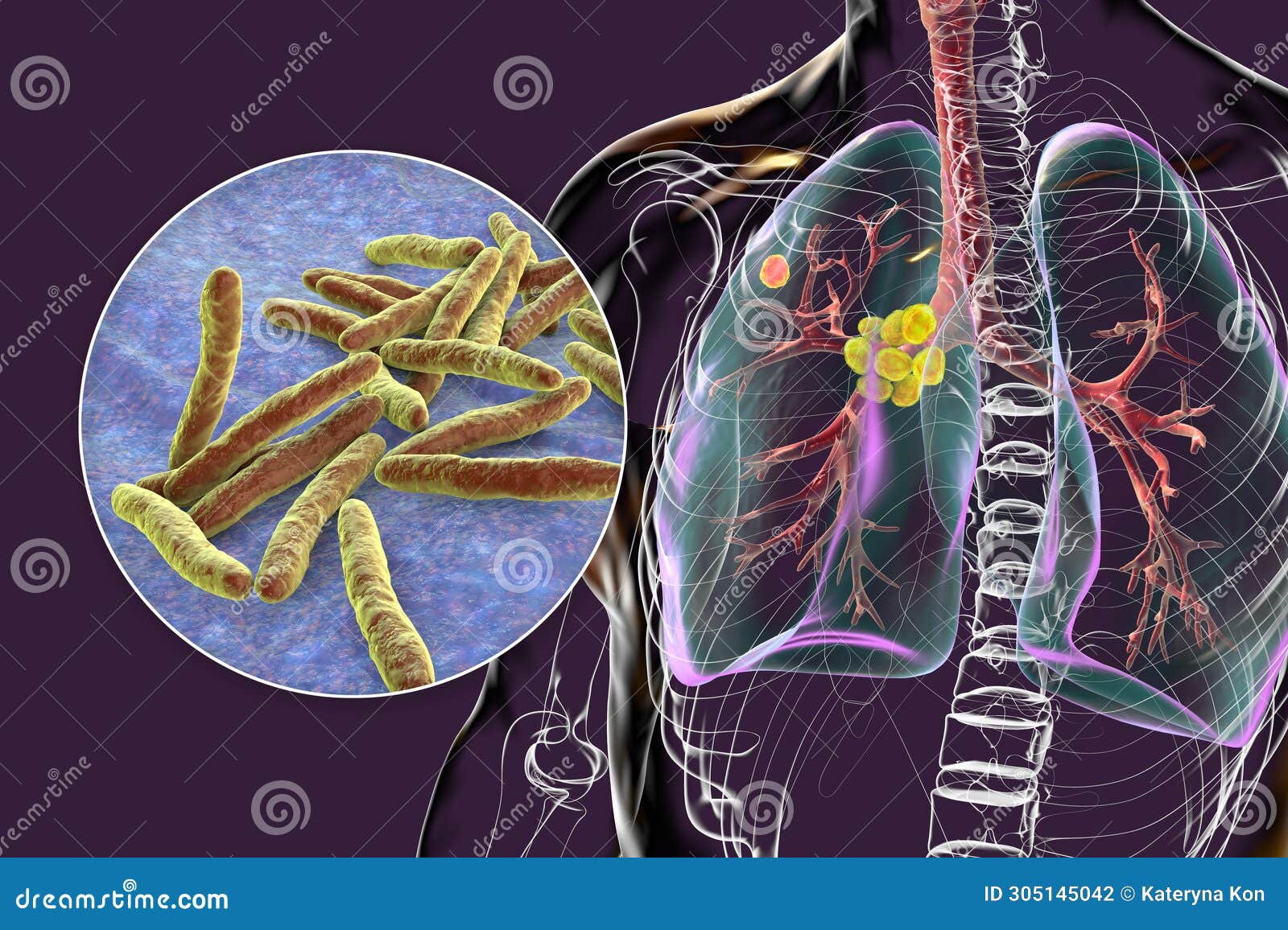 Primary Lung Tuberculosis, 3D Illustration Stock Illustration ...