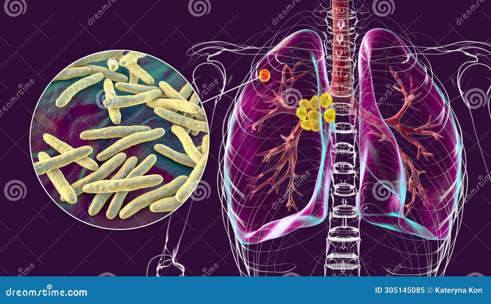 Primary Lung Tuberculosis, 3D Illustration Stock Illustration ...