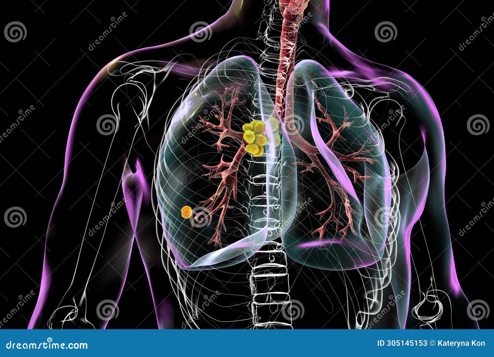 Primary Lung Tuberculosis, 3D Illustration Stock Illustration ...