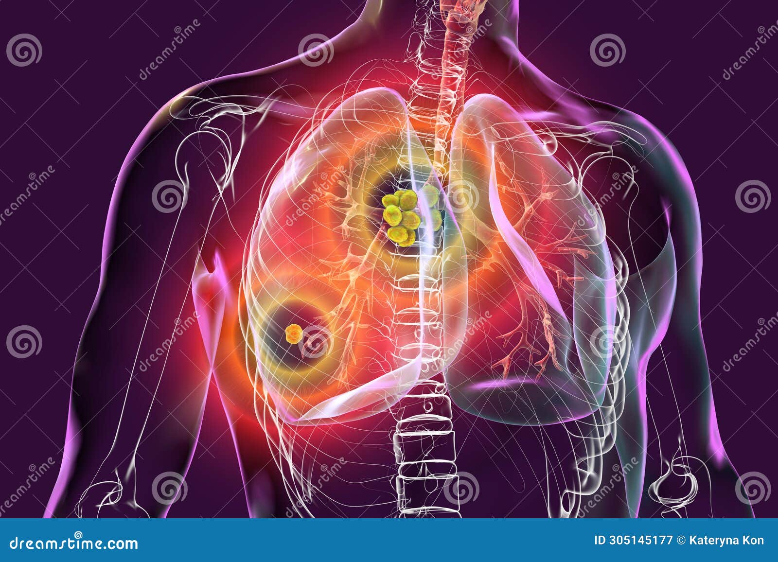Primary Lung Tuberculosis, 3D Illustration Stock Illustration ...