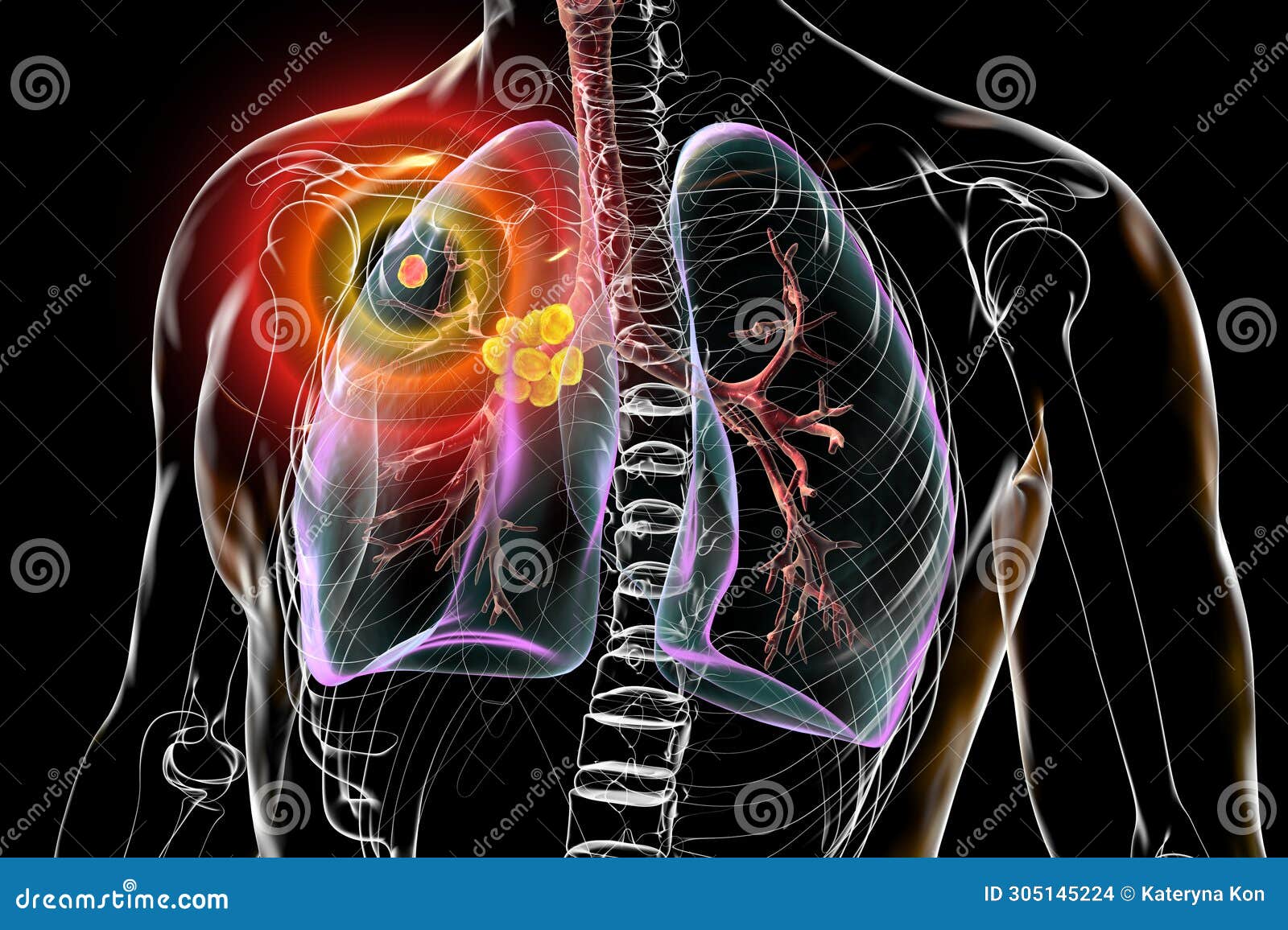 Primary Lung Tuberculosis With The Ranke Complex, 3D Illustration ...
