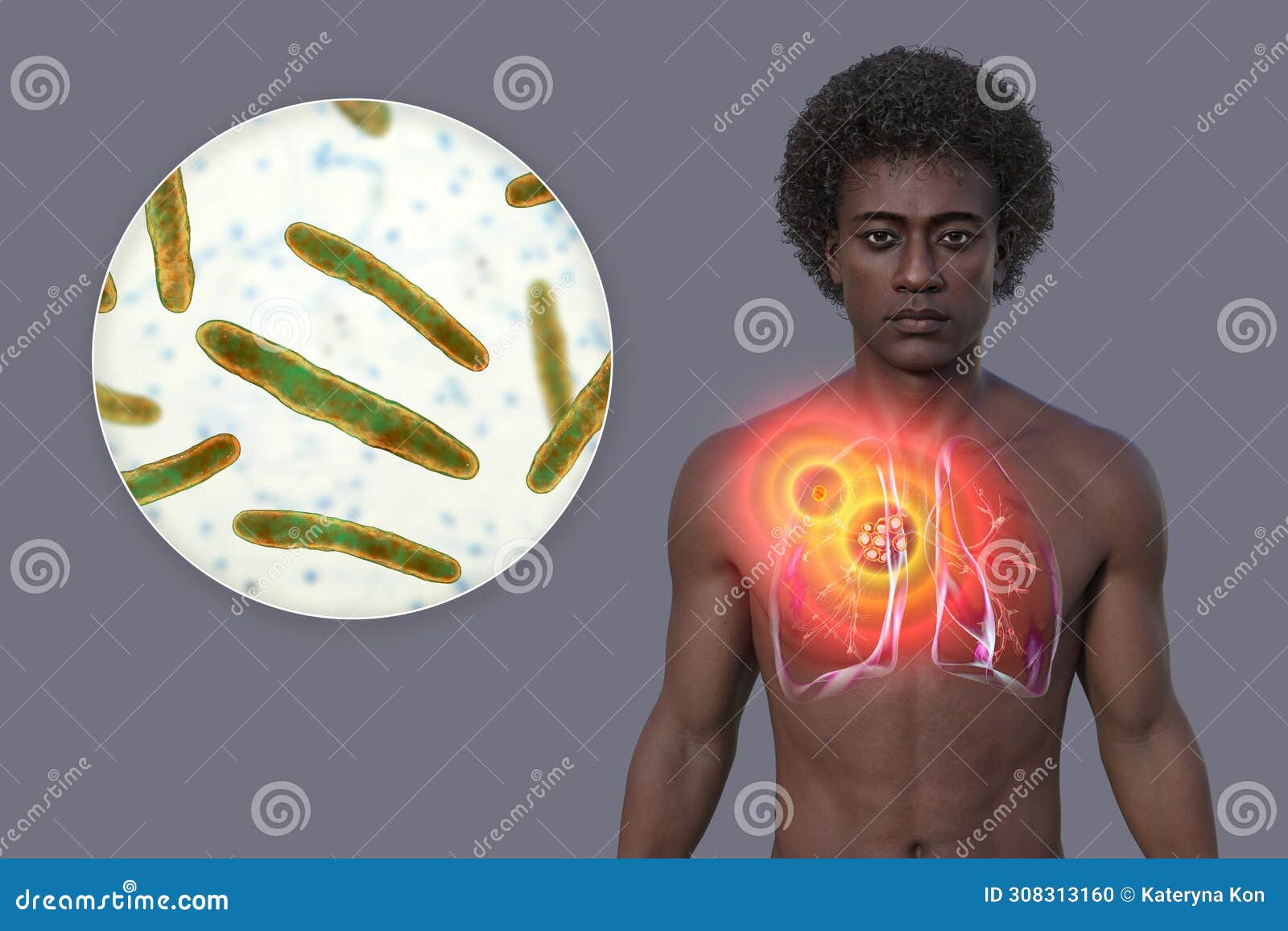 Primary Lung Tuberculosis in a Man with the Ranke Complex, 3D ...