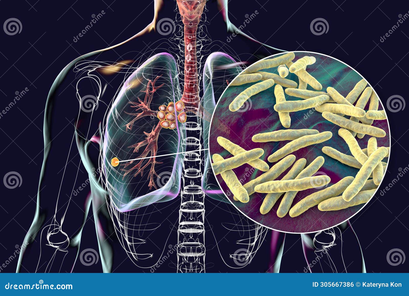 Primary Lung Tuberculosis with the Ranke Complex, 3D Illustration Stock ...