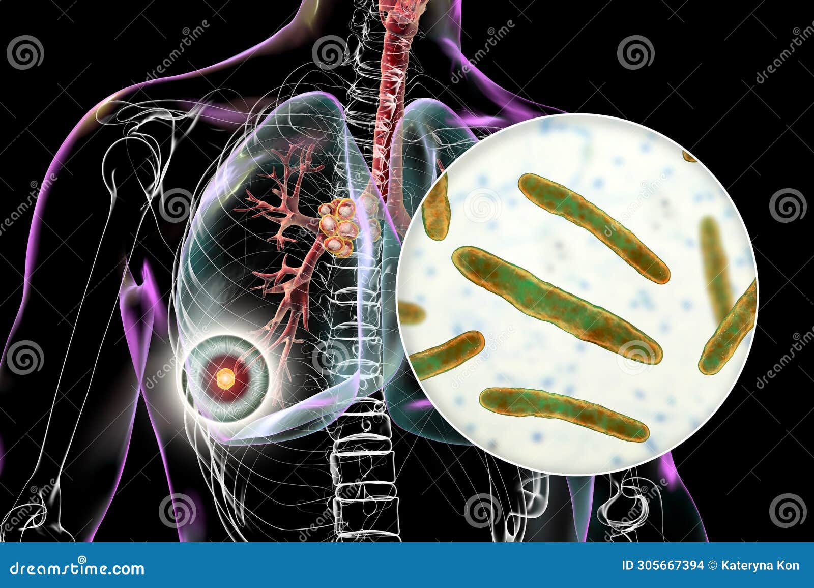 Primary Lung Tuberculosis With The Ranke Complex, 3D Illustration ...