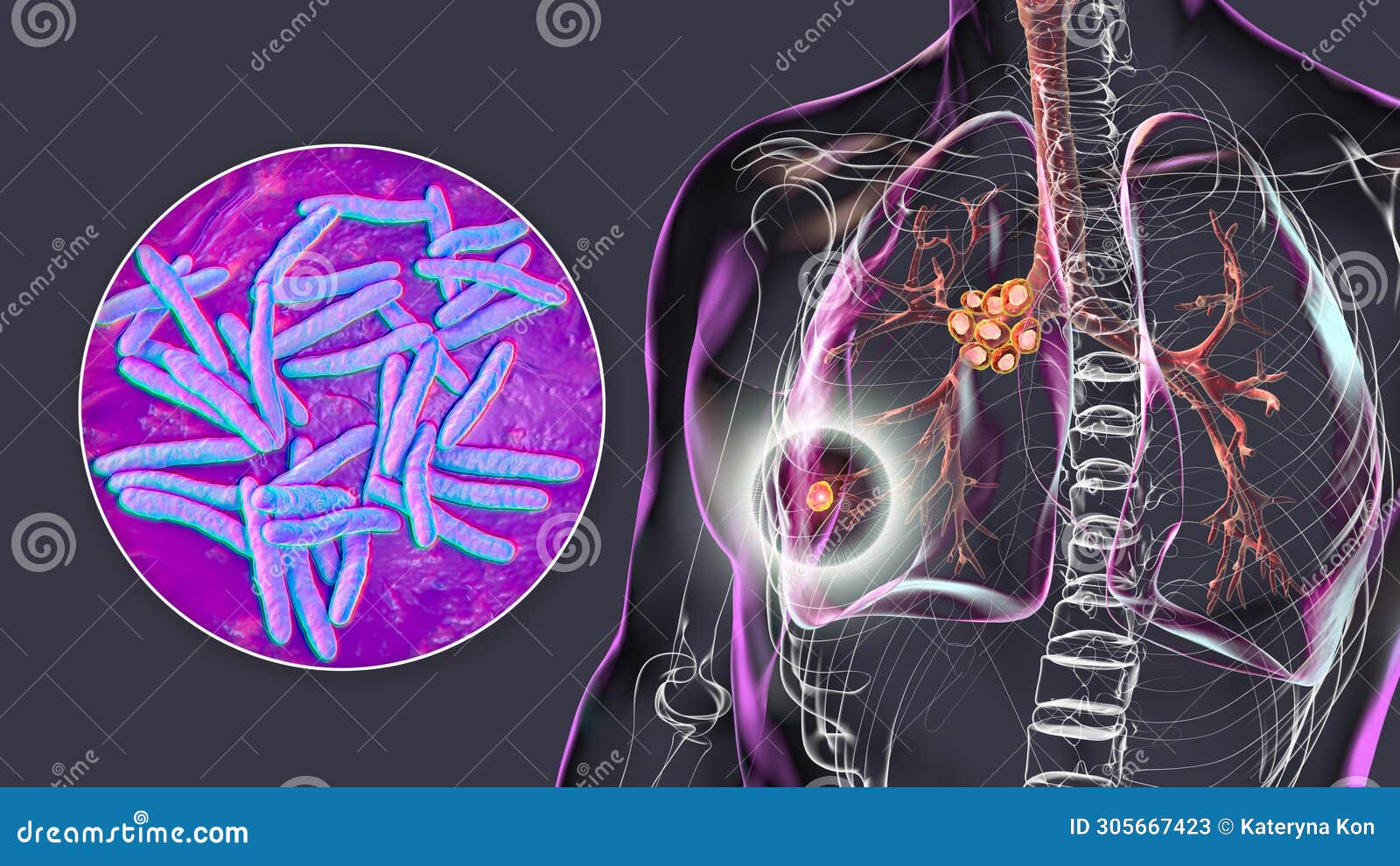 Primary Lung Tuberculosis with the Ranke Complex, 3D Illustration Stock ...