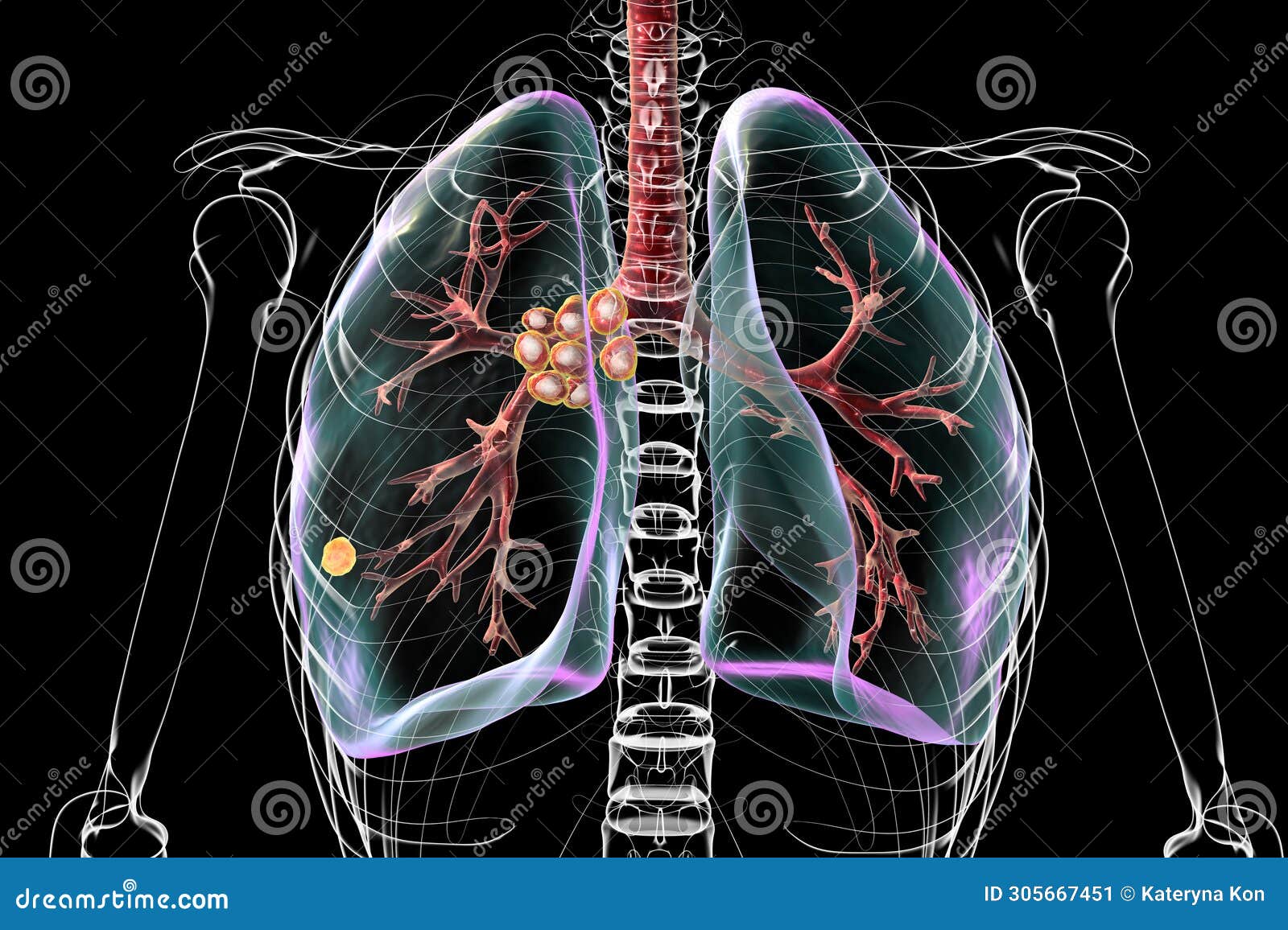 Primary Lung Tuberculosis with the Ranke Complex, 3D Illustration Stock ...