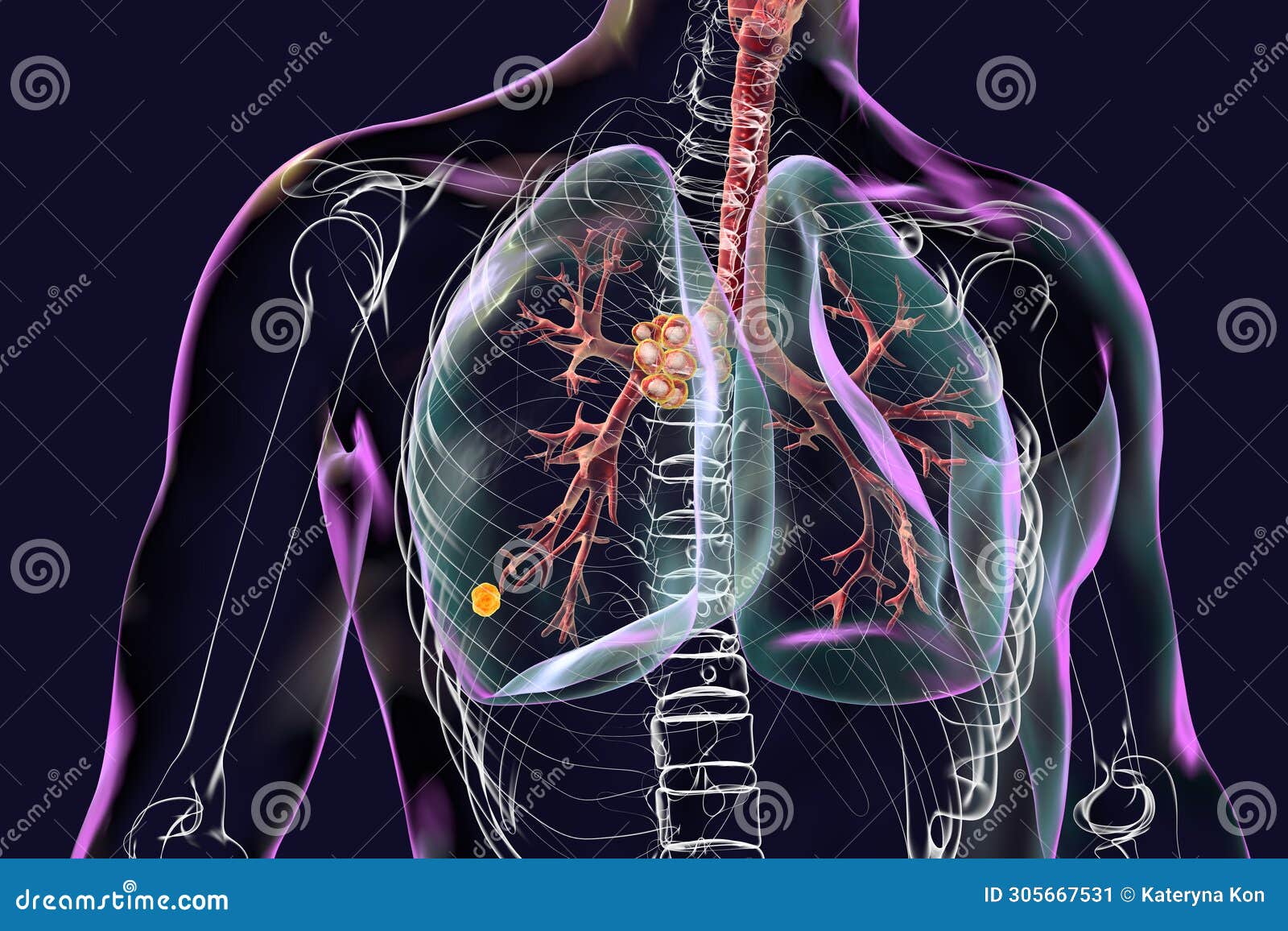 Primary Lung Tuberculosis With The Ranke Complex, 3D Illustration ...