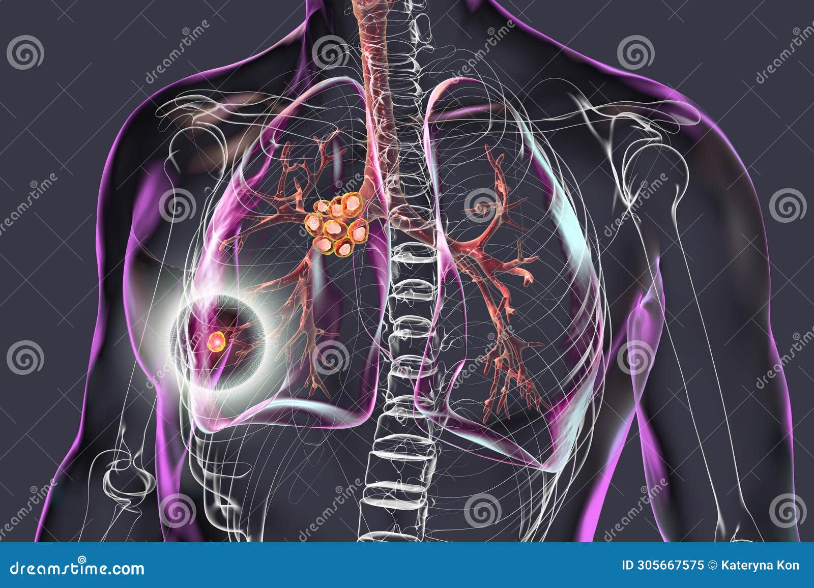 Primary Lung Tuberculosis With The Ranke Complex, 3D Illustration ...
