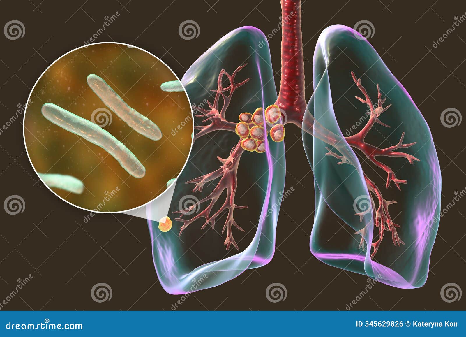 Primary Lung Tuberculosis with the Ranke Complex, 3D Illustration Stock ...