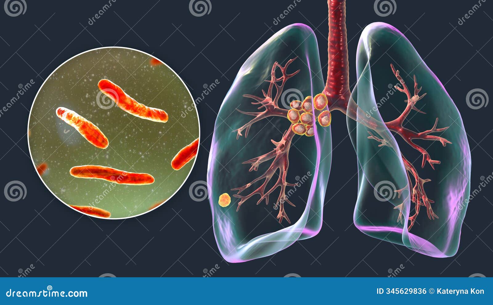 Primary Lung Tuberculosis with the Ranke Complex, 3D Illustration Stock ...