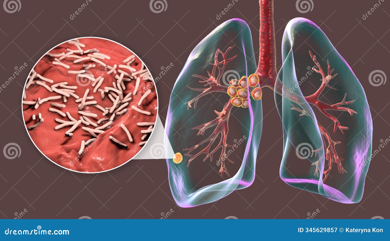 Primary Lung Tuberculosis with the Ranke Complex, 3D Illustration Stock ...