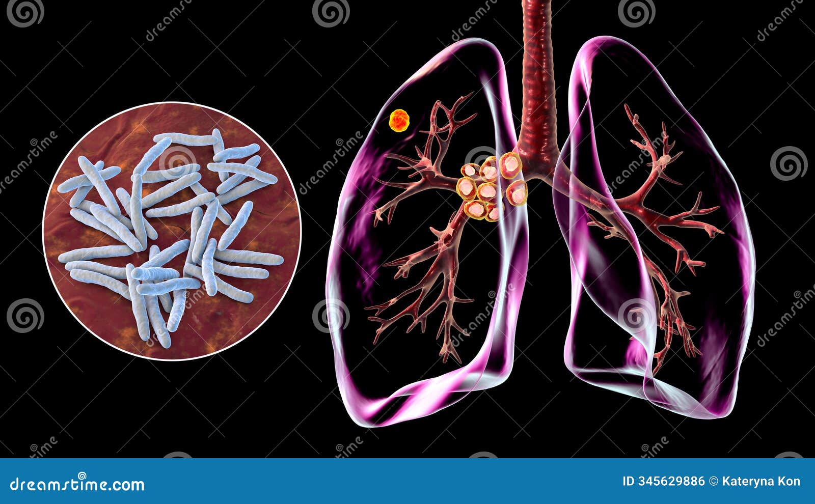 Primary Lung Tuberculosis with the Ranke Complex, 3D Illustration Stock ...