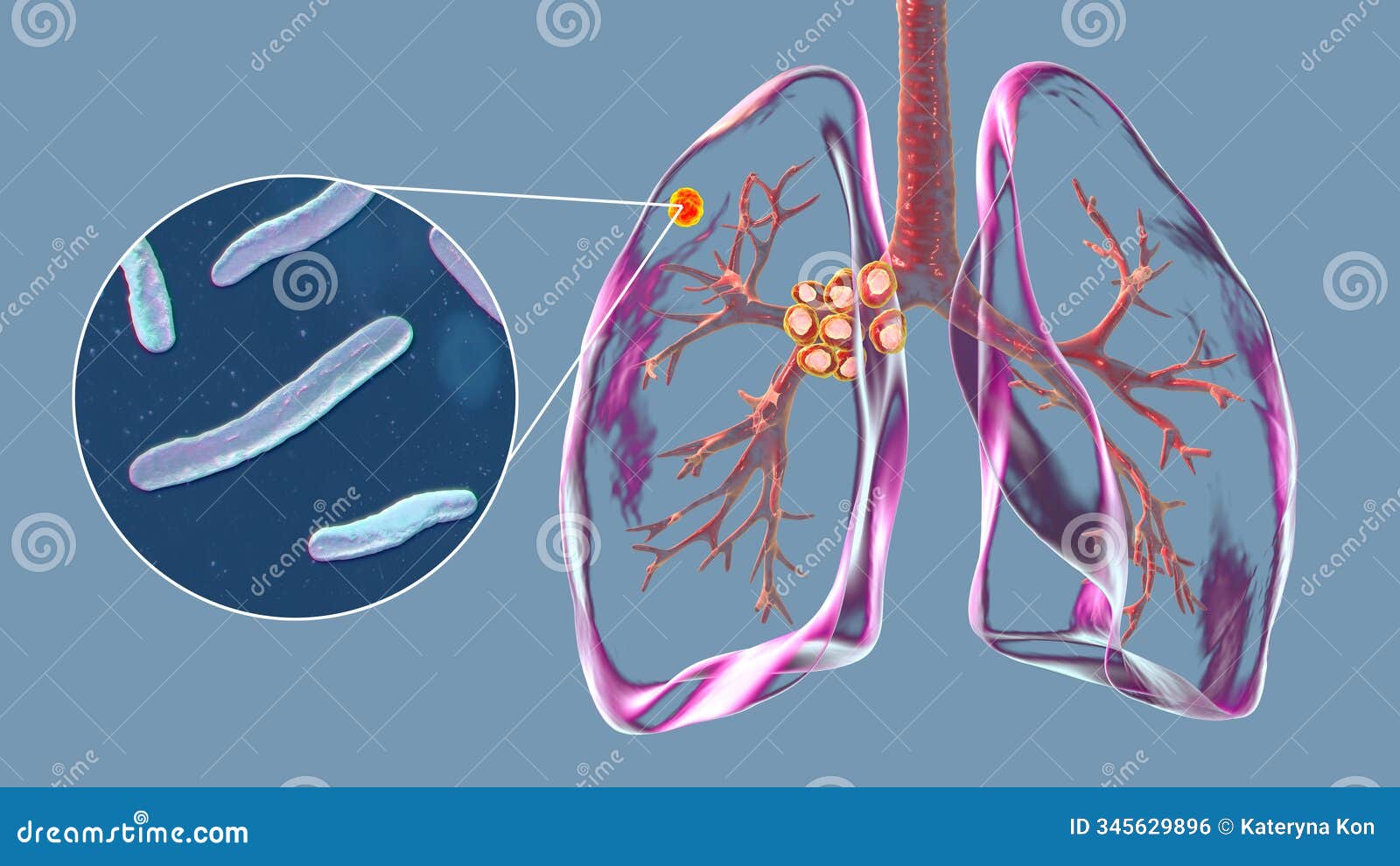 Primary Lung Tuberculosis with the Ranke Complex, 3D Illustration Stock ...